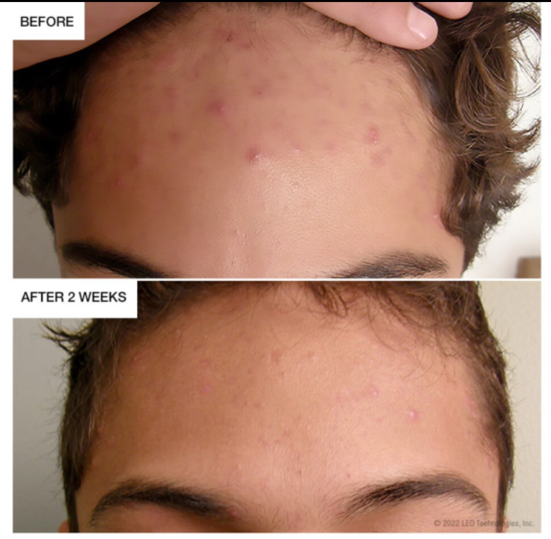 package-singlerlacne | Hexagon